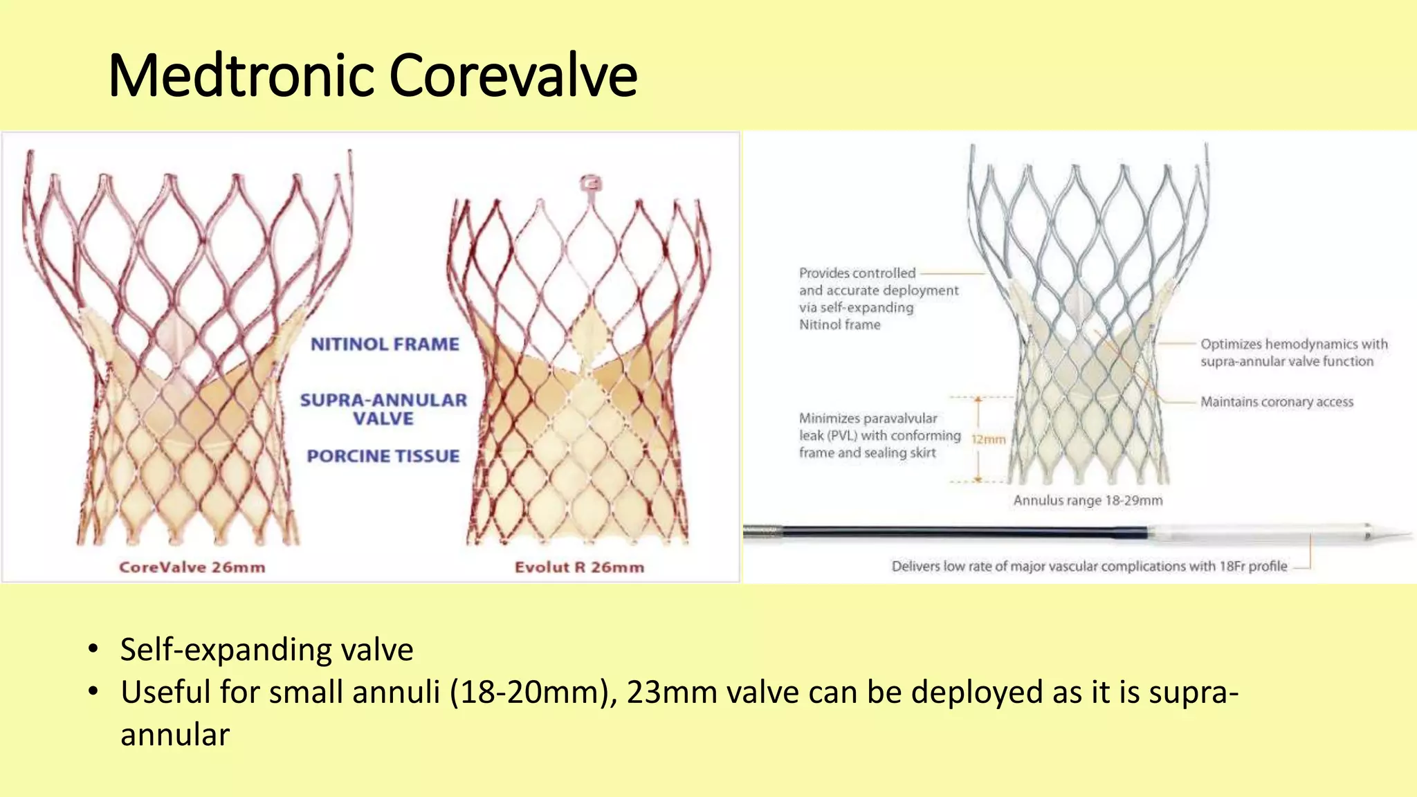 TAVI - Transcatheter Aortic Valve Implantation | PPT
