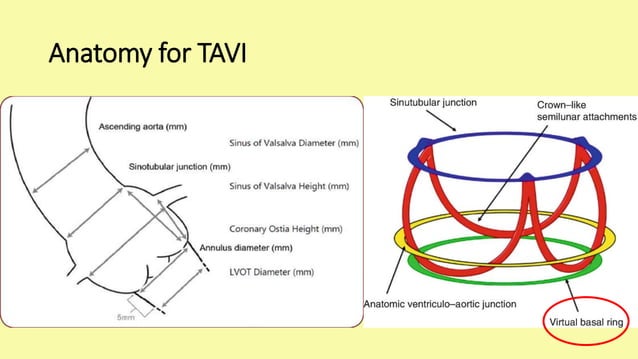 TAVI - Transcatheter Aortic Valve Implantation | PPTX | Heart and ...