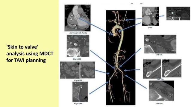 TAVI - Transcatheter Aortic Valve Implantation | PPTX | Heart and ...