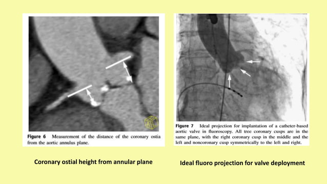 TAVI - Transcatheter Aortic Valve Implantation | PPTX | Heart and ...