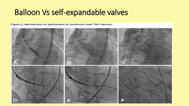 TAVI - Transcatheter Aortic Valve Implantation | PPTX | Heart and ...
