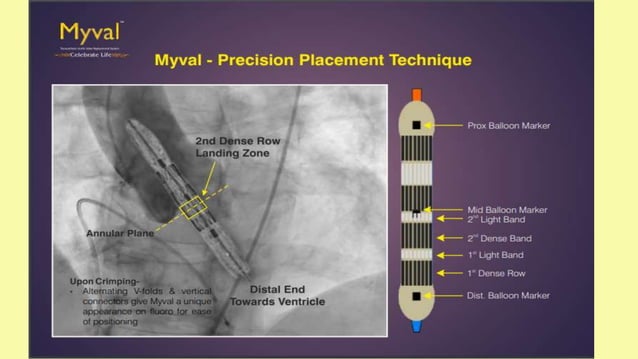 TAVI - Transcatheter Aortic Valve Implantation | PPTX | Heart and ...