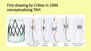 TAVI - Transcatheter Aortic Valve Implantation | PPTX