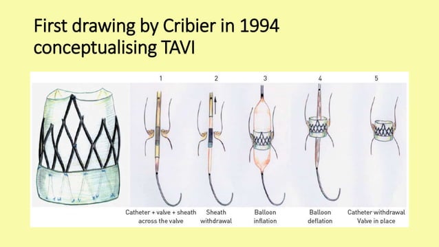 TAVI - Transcatheter Aortic Valve Implantation | PPTX | Heart and ...