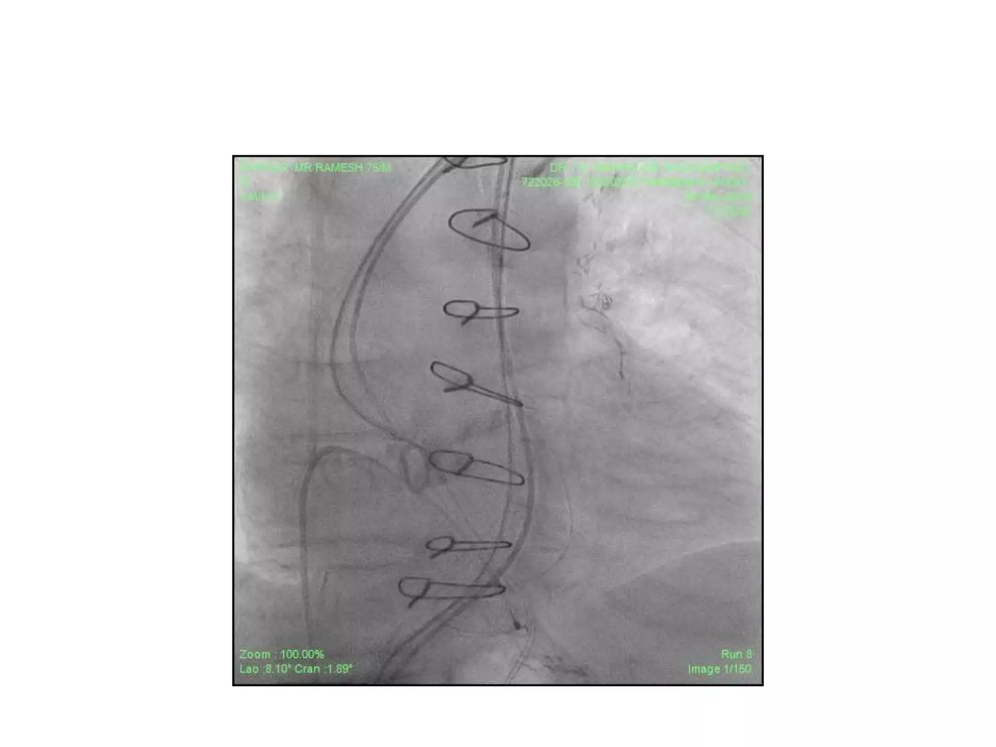 TAVR/TAVI/TRANCATHETER SAORTIC VALVE REPLECEMENT | PPTX