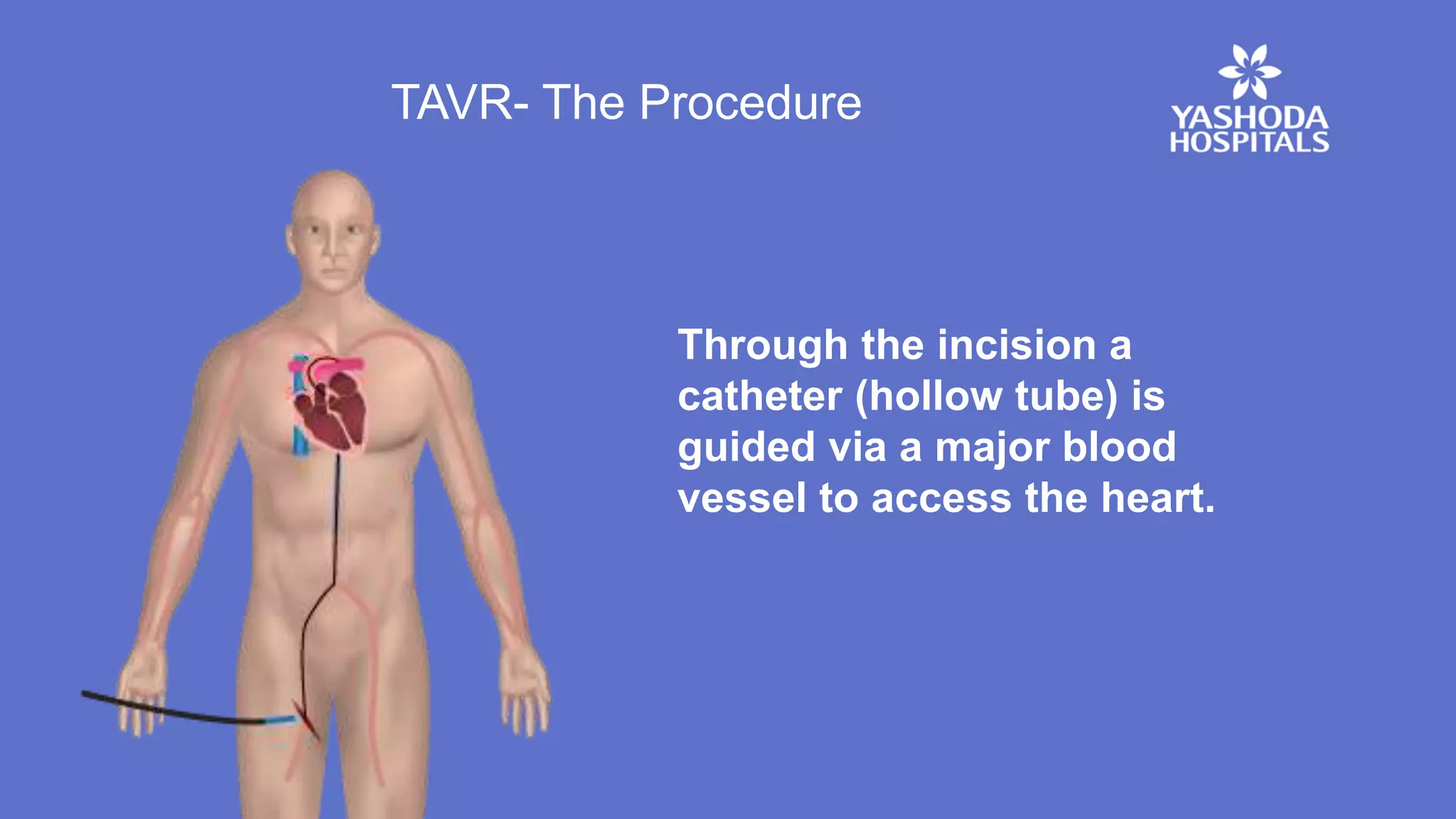 Transcatheter Aortic Valve Replacement (TAVR) | TAVR Procedure at Yashoda Hospitals | PPTX