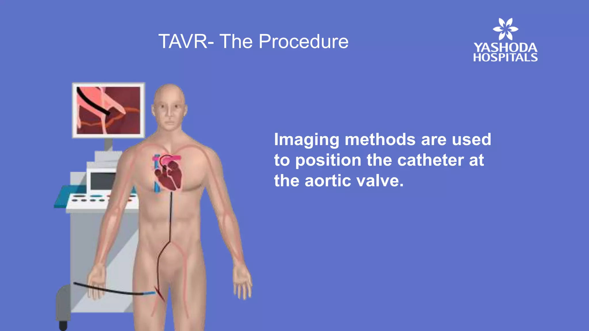 Transcatheter Aortic Valve Replacement (TAVR) | TAVR Procedure at Yashoda Hospitals | PPTX