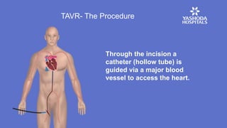 Transcatheter Aortic Valve Replacement (TAVR) | TAVR Procedure at Yashoda Hospitals | PPTX