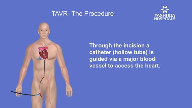 Transcatheter Aortic Valve Replacement (TAVR) | TAVR Procedure at Yashoda Hospitals | PPTX ...