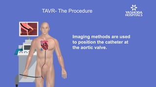Transcatheter Aortic Valve Replacement (TAVR) | TAVR Procedure at Yashoda Hospitals | PPTX