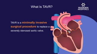 Transcatheter Aortic Valve Replacement (TAVR) | TAVR Procedure at Yashoda Hospitals | PPTX