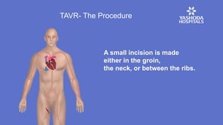 Transcatheter Aortic Valve Replacement (TAVR) | TAVR Procedure at Yashoda Hospitals | PPTX