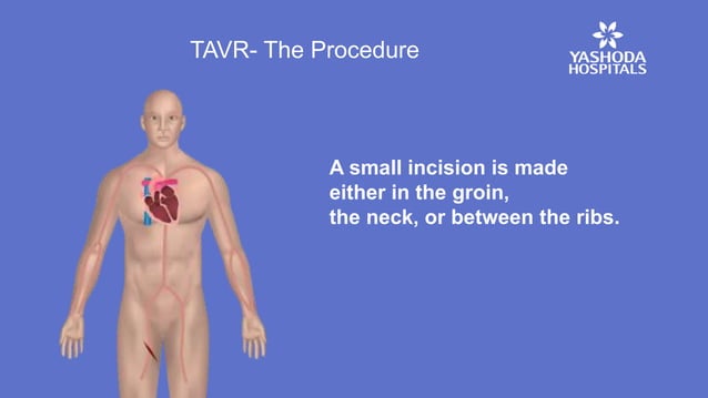 Transcatheter Aortic Valve Replacement (TAVR) | TAVR Procedure at Yashoda Hospitals | PPTX ...