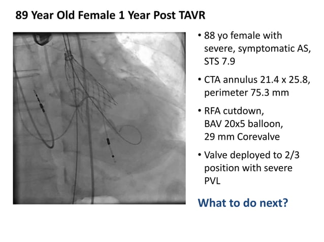 Tavr case review 3 18-14 | PPT