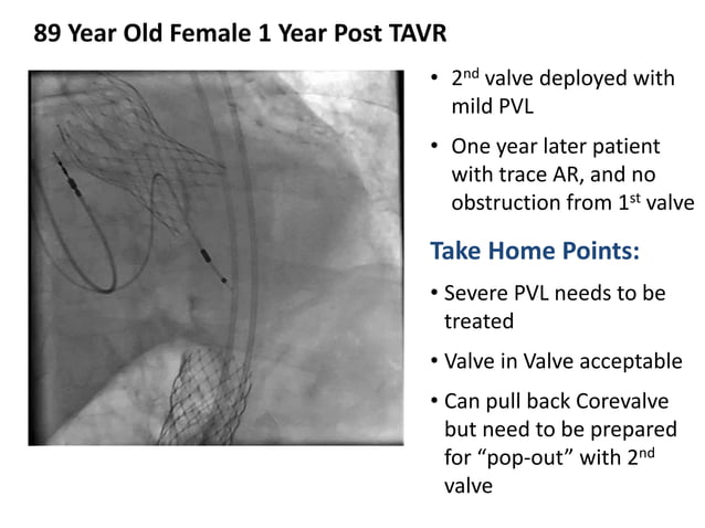 Tavr case review 3 18-14 | PPT