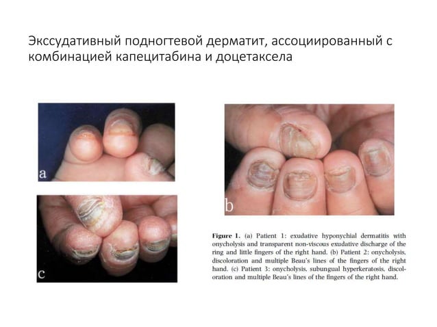 Taxane - management of side effects | PPT