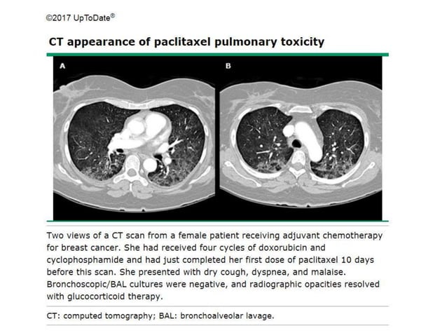 Taxane - management of side effects | PPT