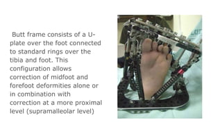 Taylor spatial frame | PPTX