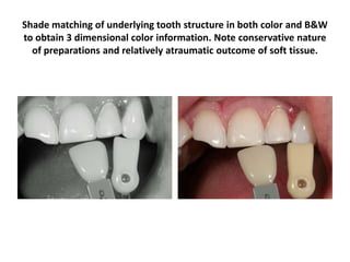 Taylor veneer website | PPT