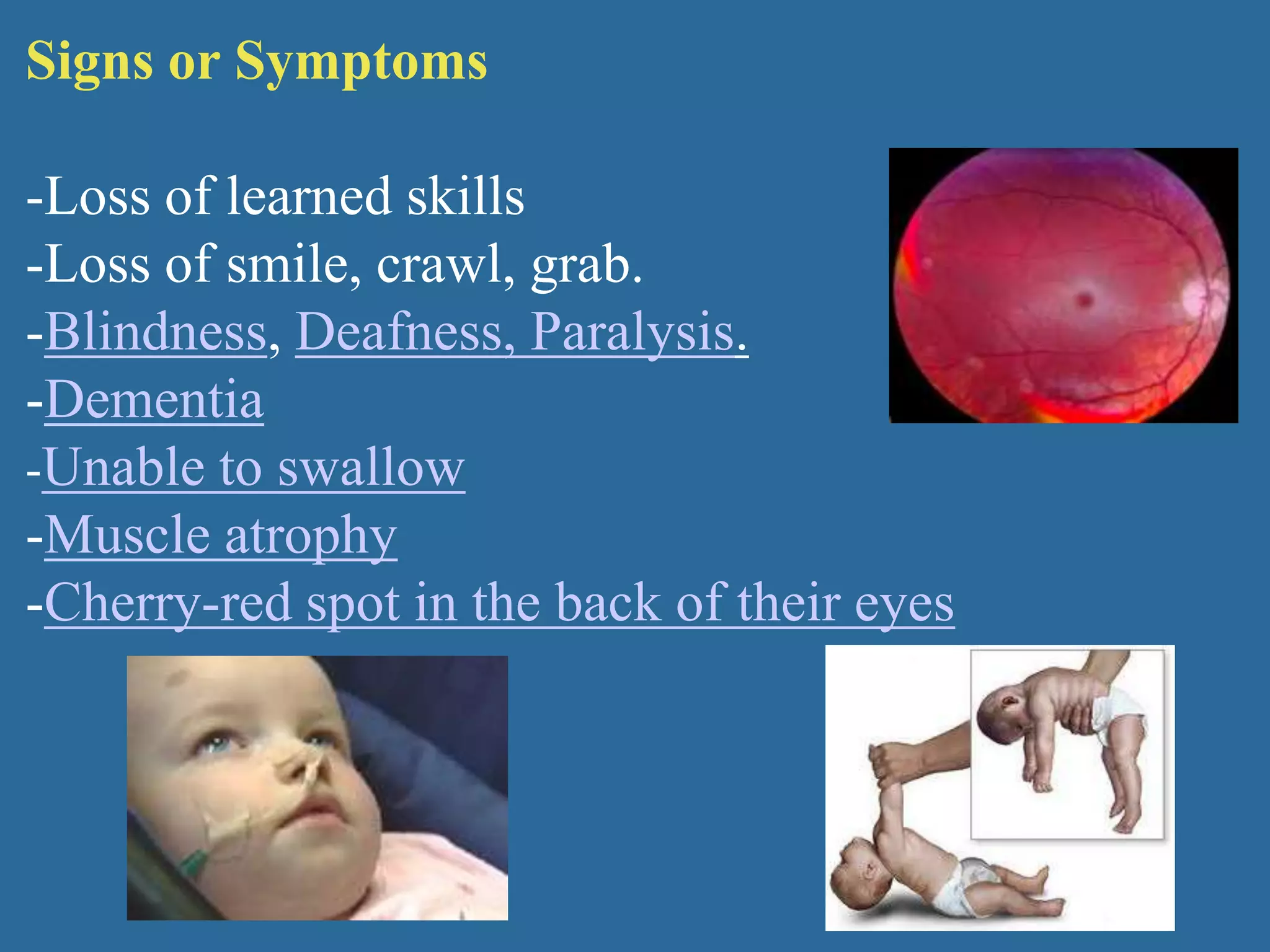 Tay sachs DISEASE | PPTX