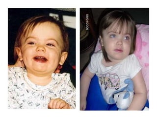 Tay – sachs disease | PPTX