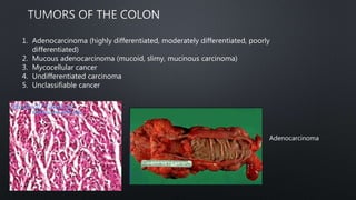 Benign and malignant tumors of GIT | PPTX