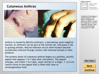 Cutaneous Antrax & Its Mimics | PPT