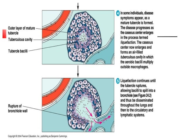 Tuberclosis | PPT