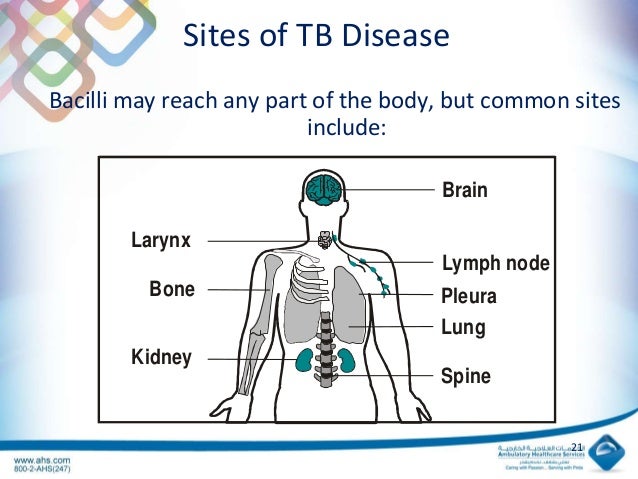 TUBERCULOSIS