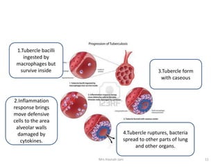 Tb | PPTX | Lung and Respiratory Health | Diseases and Conditions