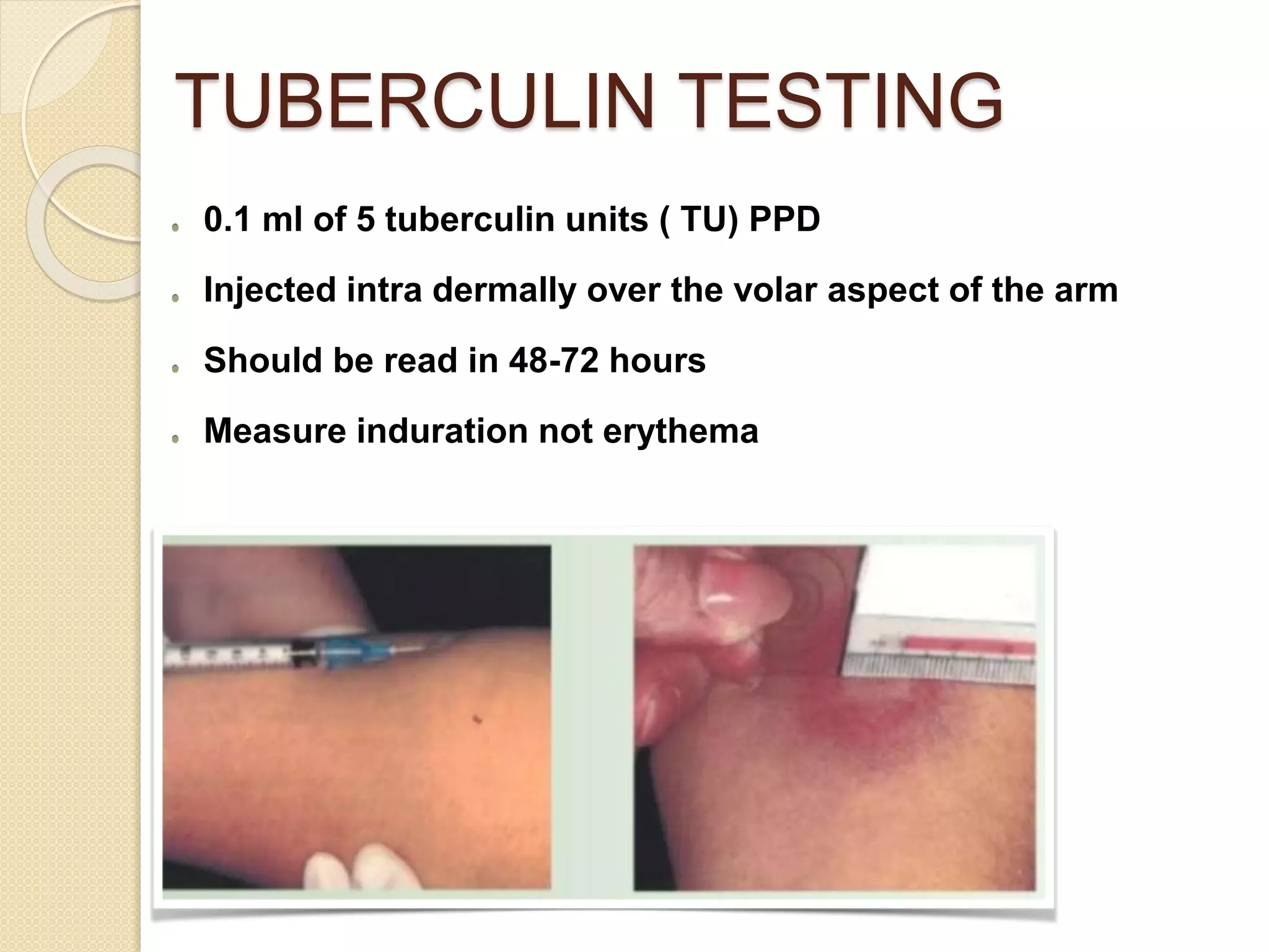TUBERCULOSIS | PPTX
