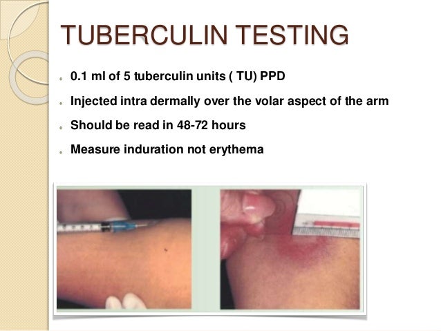 TUBERCULOSIS