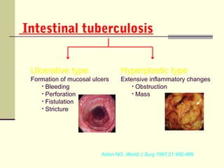 Abdominal tuberculosis | PPT