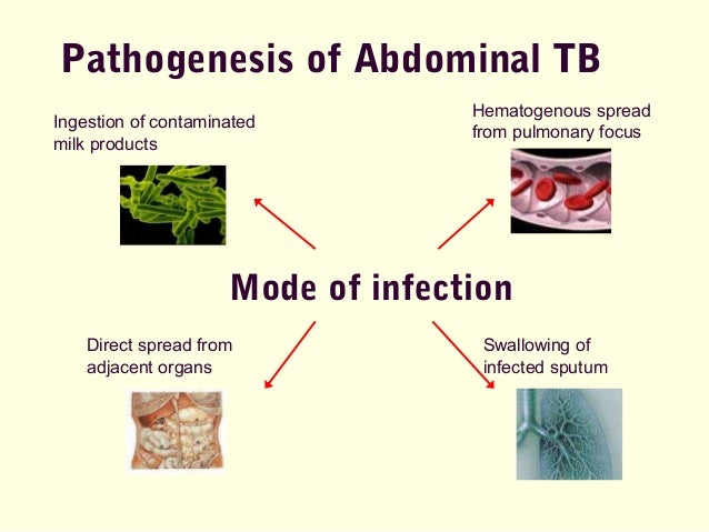 Abdominal tuberculosis
