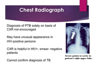 Tuberculosis | PPT