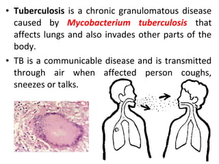 Tuberculosis | PPT
