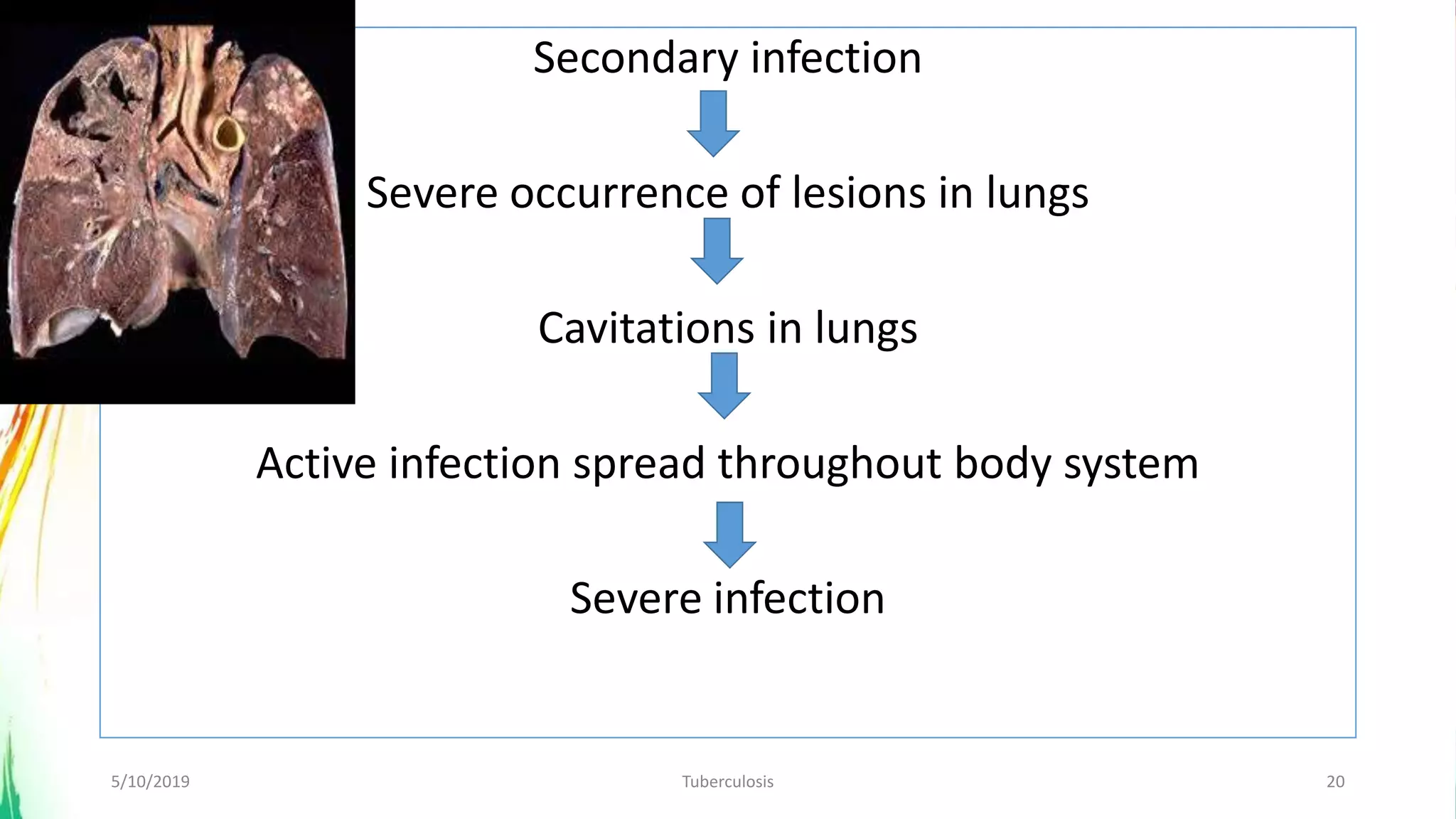 Tb TUBERCULOSIS | PPTX