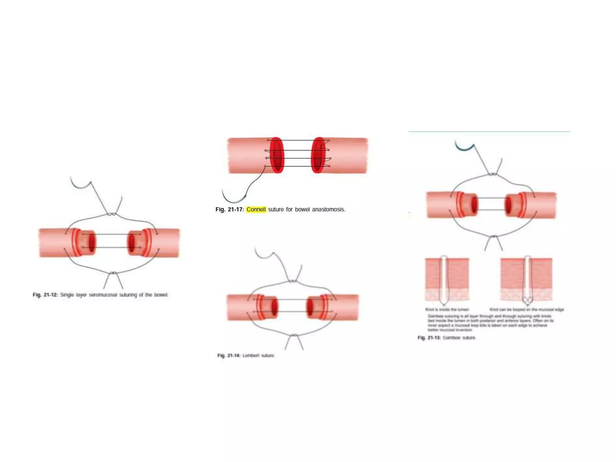 Etrapulmonary tuberculosis surgical management and recent advances | PPT