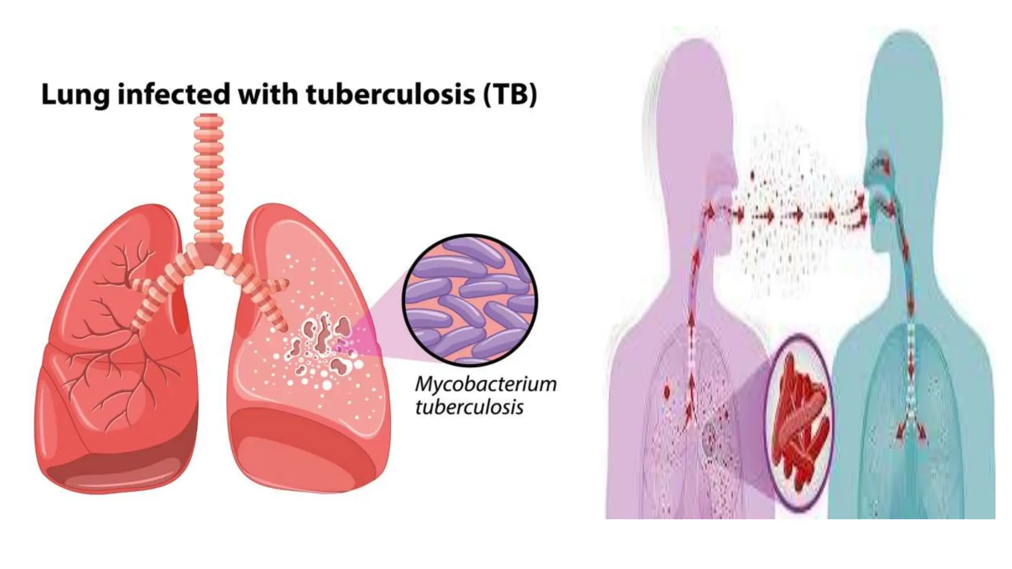 What is Tuberculosis TB management of Tb | PPTX