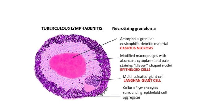 Tuberculosis histology pictures explained.pptx