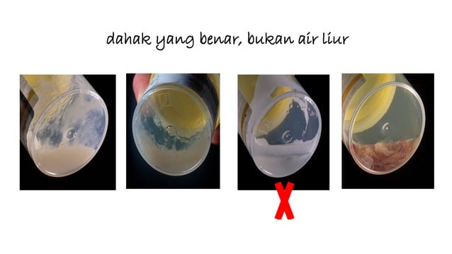 TB paru merupakan penyakit yang kronis pada setiap orang | PPT