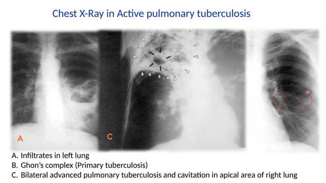 Mycobacterium tuberculosis diagnosis and treatment.pptx