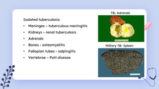 Tuberculosis, primary and secondary tuberculosis | PDF