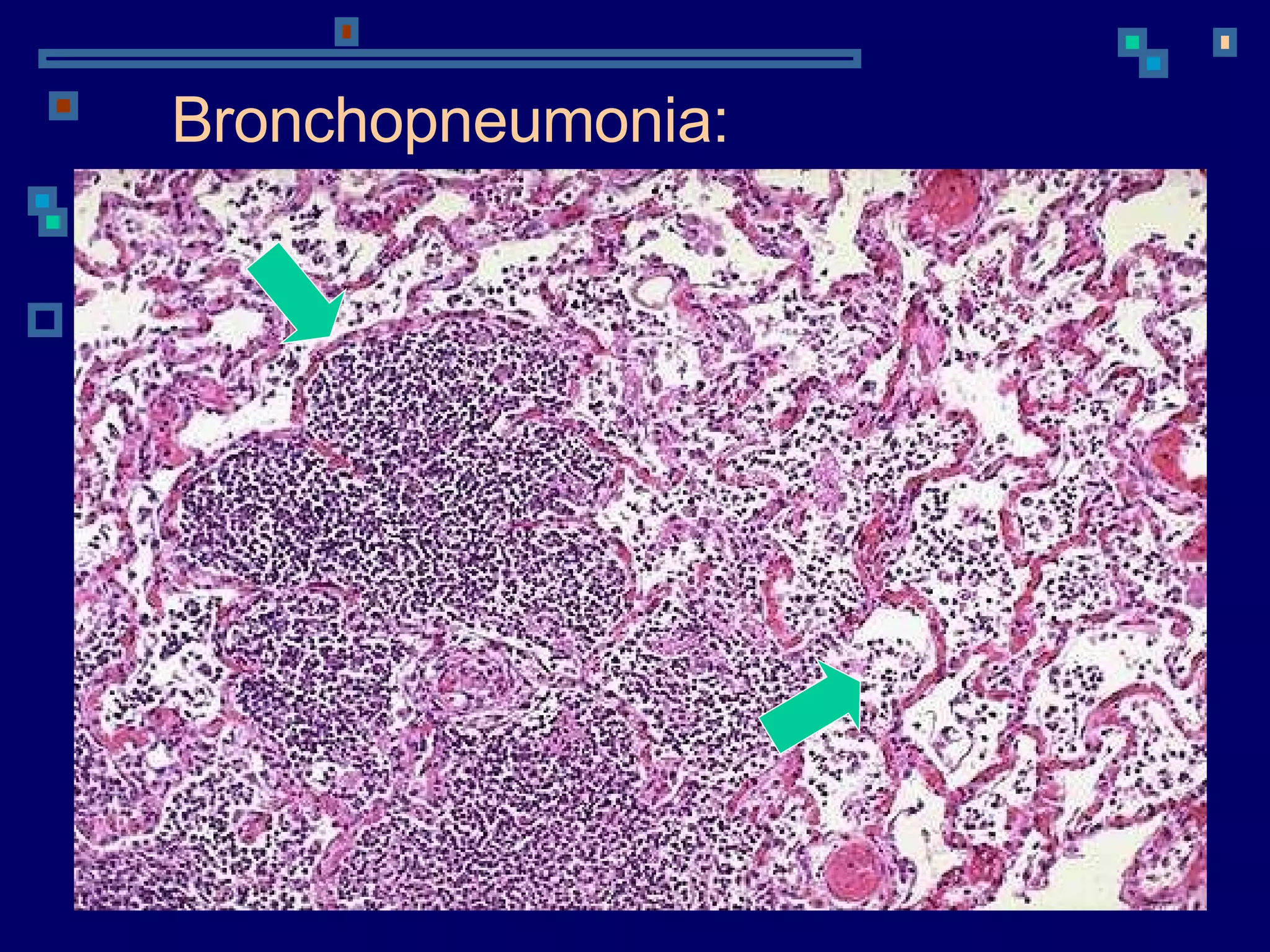 Pathology of Pneumonia | PPS