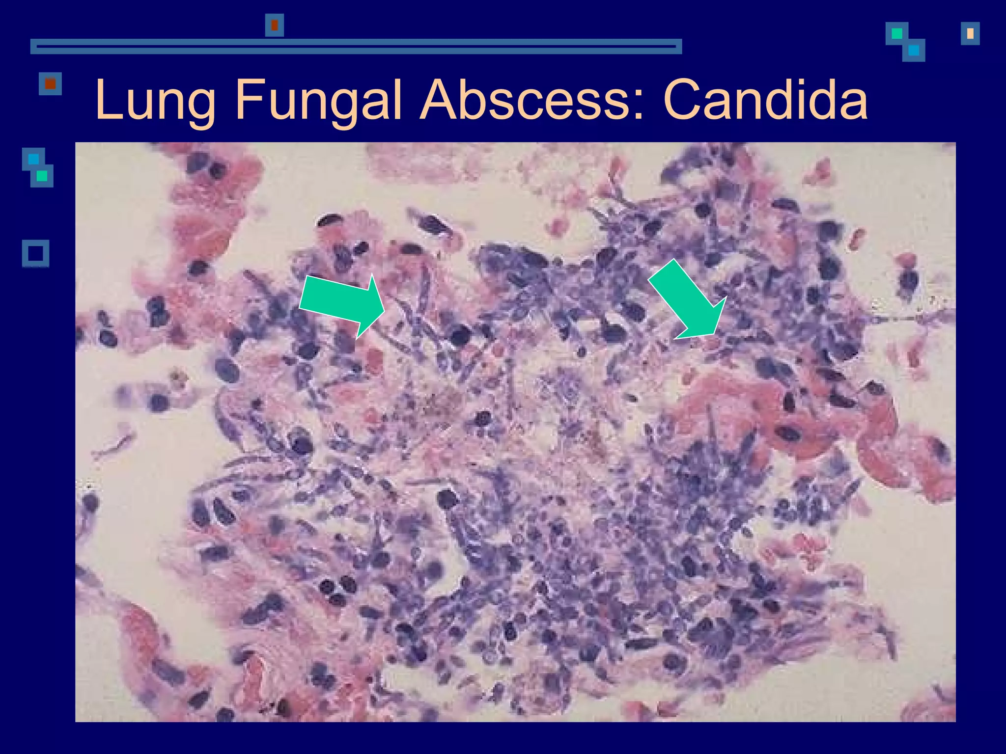 Pathology of Pneumonia | PPS