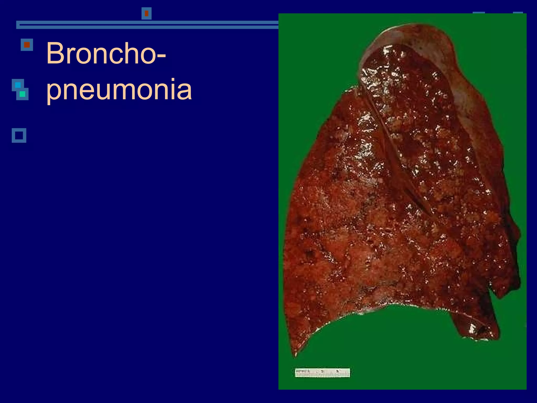 Pathology of Pneumonia | PPS