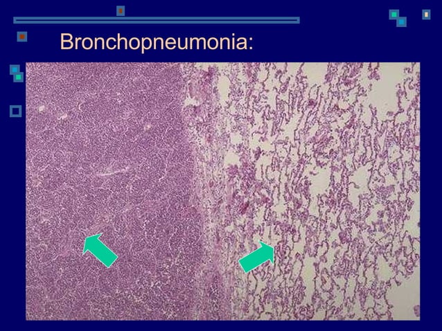Pathology of Pneumonia | PPS