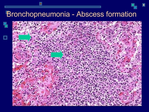 Pathology of Pneumonia | PPS