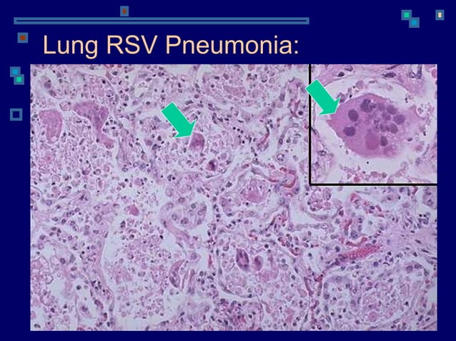Pathology of Pneumonia | PPS