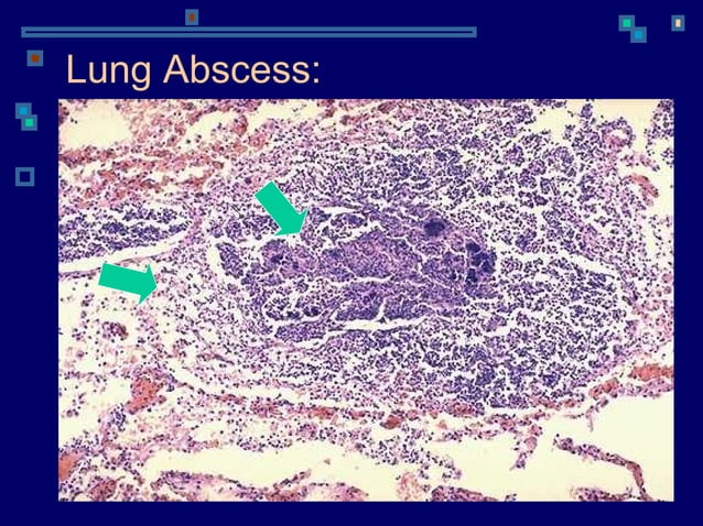 Pathology of Pneumonia | PPS